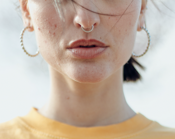 What’s Triggering Your Acne? Top Causes & Preventative Tips – Dr. Zenovia